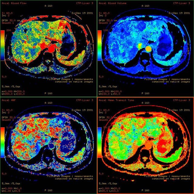 CT Perfusion 4D Multi-organs | GE Healthcare (Spain)